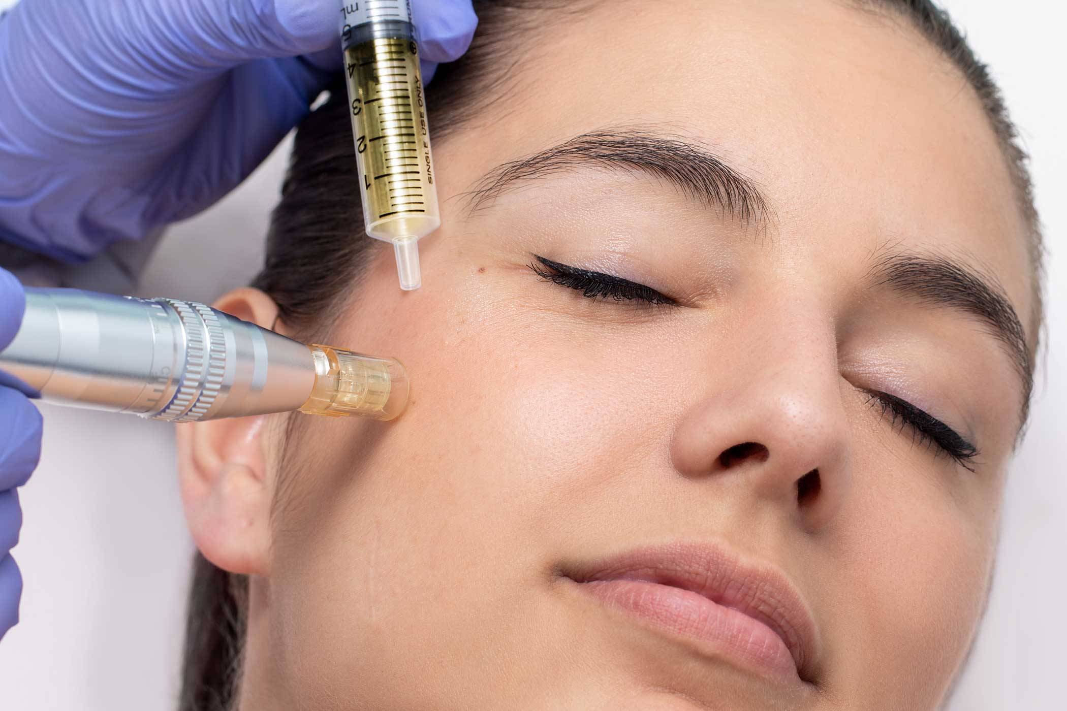 Dermapen (Micro Needling)